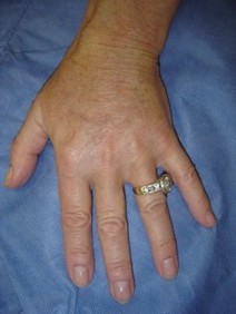 Hand Vein Treatment (Laser / Sclerotherapy) | Vanish Vein treats ...