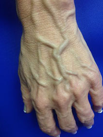 Hand Vein Treatment (Laser / Sclerotherapy) | Vanish Vein treats ...