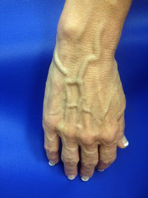 Hand Vein Treatment (Laser / Sclerotherapy) | Vanish Vein treats ...