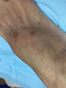 Vanish Vein Before & After Photos | Vanish Vein treats Varicose Veins ...