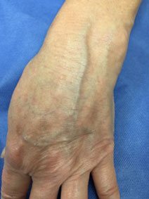 Hand Vein Treatment (Laser / Sclerotherapy) | Vanish Vein treats ...