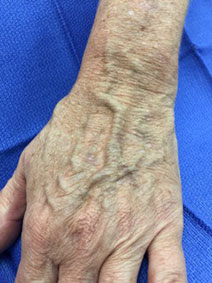 Hand Vein Treatment (Laser / Sclerotherapy) | Vanish Vein treats ...