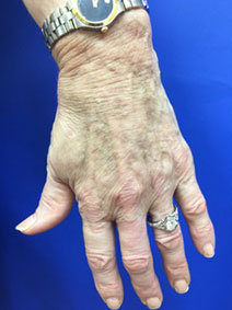 Hand Vein Treatment (Laser / Sclerotherapy) | Vanish Vein treats ...