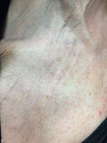 Vanish Vein Before & After Photos | Vanish Vein treats Varicose Veins ...