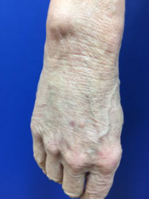 Hand Vein Treatment (Laser / Sclerotherapy) | Vanish Vein treats ...