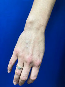 Hand Vein Treatment (Laser / Sclerotherapy) | Vanish Vein treats ...