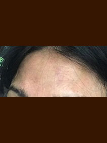 Vanish Vein Before & After Photos | Vanish Vein treats Varicose Veins ...