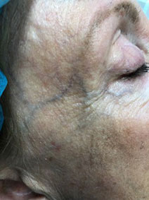 Vanish Vein Before & After Photos | Vanish Vein treats Varicose Veins ...