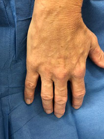 Hand Vein Treatment (Laser / Sclerotherapy) | Vanish Vein treats ...