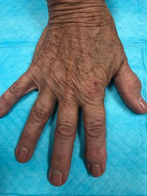 Hand Vein Treatment (Laser / Sclerotherapy) | Vanish Vein treats ...