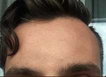 Forehead Vein Treatments - Vanish Vein treats Varicose Veins in Naples ...