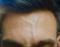 Forehead Vein Treatments - Vanish Vein treats Varicose Veins in Naples ...